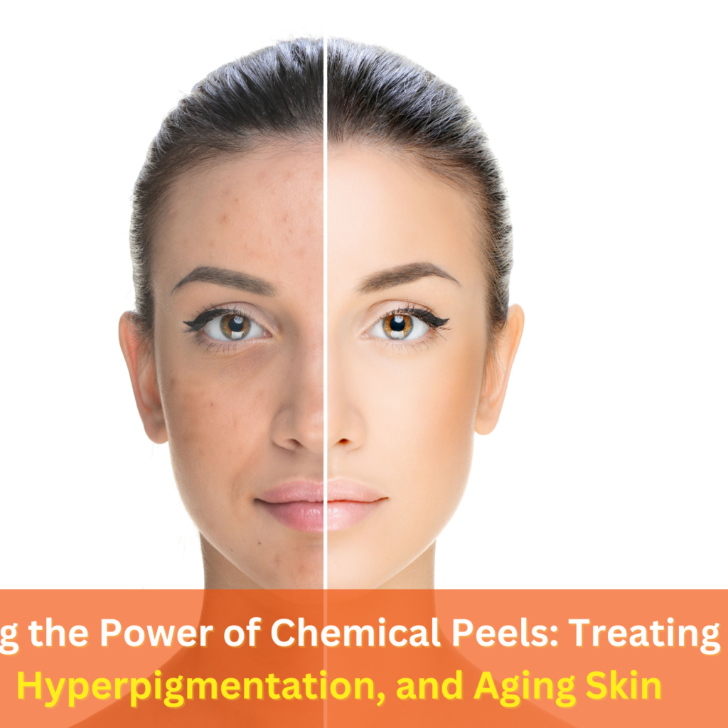 The Use of Chemical Peels in Treating Acne, Hyperpigmentation, and ...