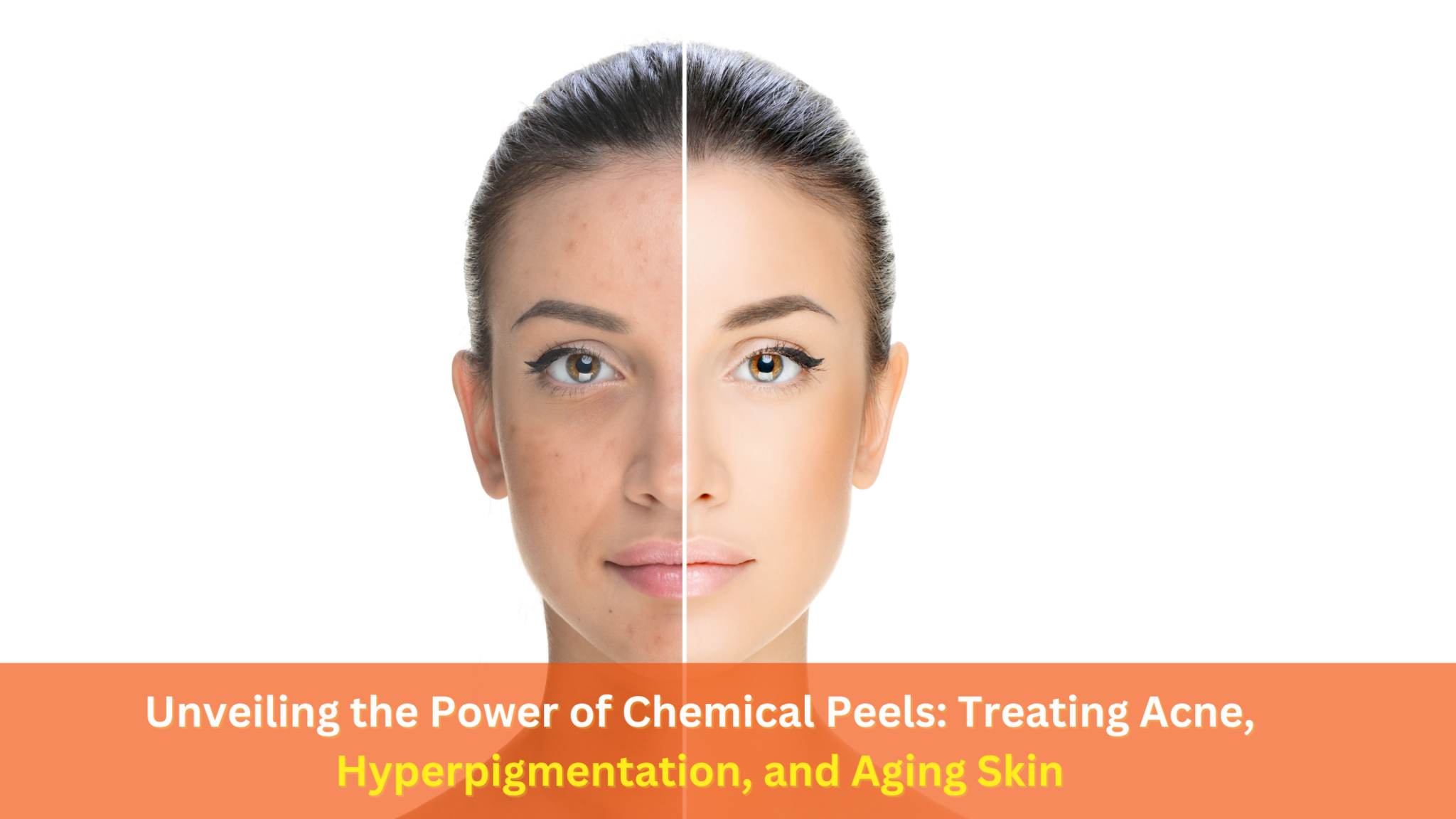 The Use of Chemical Peels in Treating Acne, Hyperpigmentation, and ...